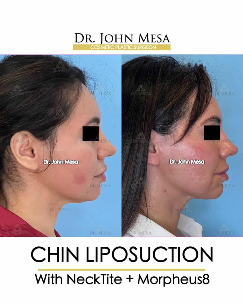 Chin Liposuction Before & After Photos | Dr. Mesa