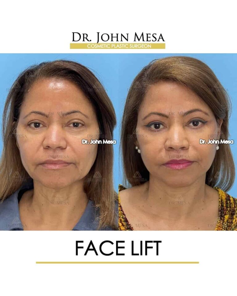 🥇 Facelift Under Local Anesthesia NYC | Dr. Mesa
