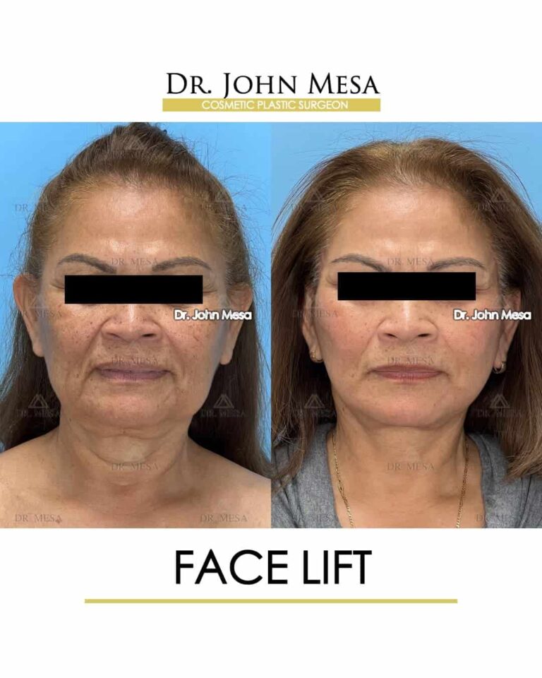 🥇 Facelift Under Local Anesthesia NYC | Dr. Mesa