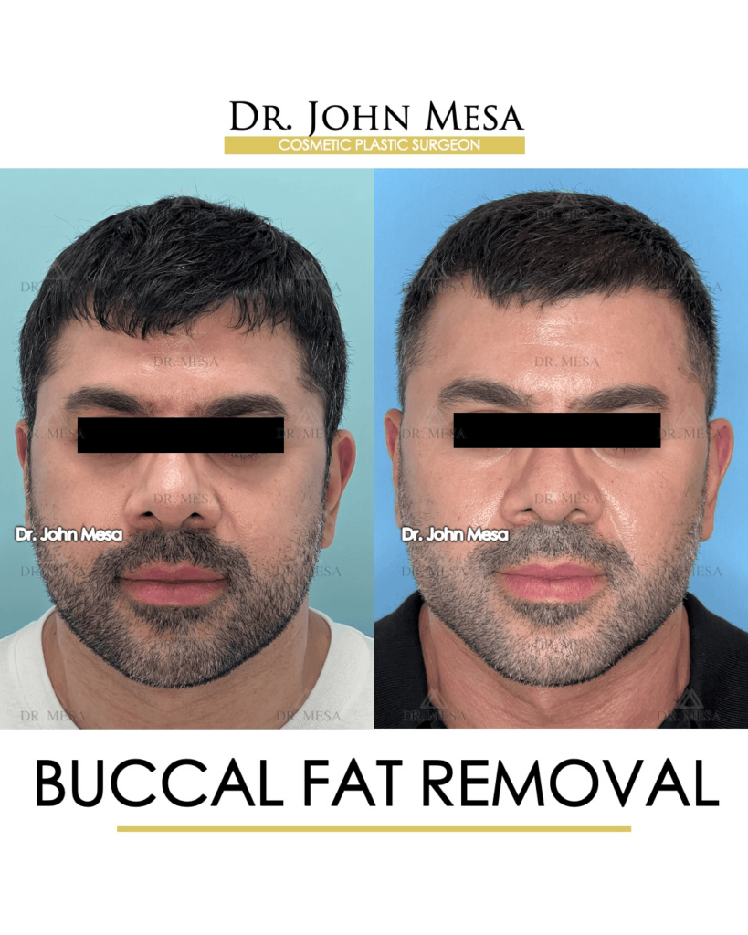 🥇 Buccal Fat Removal For Men NYC, New Jersey, and Miami