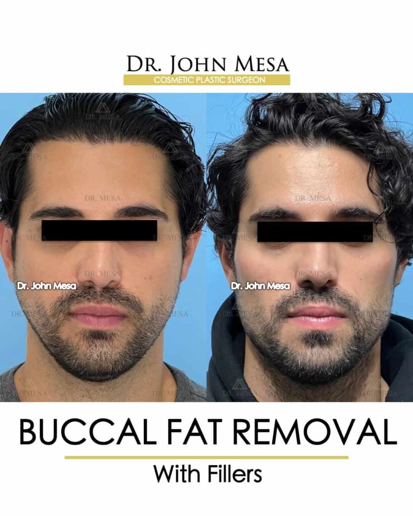 🥇 Buccal Fat Removal For Men NYC, New Jersey, and Miami